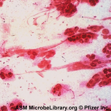 Many Gram negative coccobacilli and white cells
